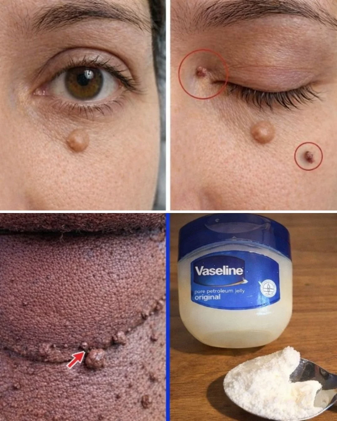 Those Stubborn Little White Bumps: Understanding Milia and Safe Ways to ...